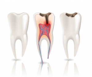 ¿QUÉ ES LA CARIES Y CÓMO SE DESARROLLA?